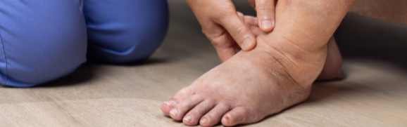 Lipoedema: Causes, symptoms, and treatment explained - Carenity