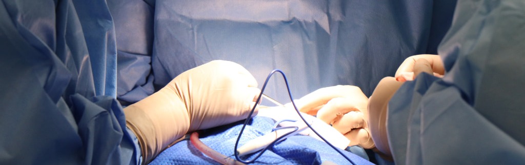 Different types of epilepsy surgery for a better quality of life - Carenity